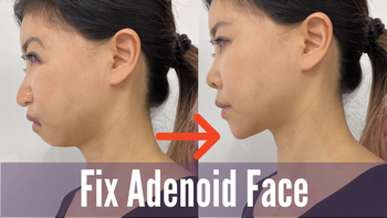 What is Adenoid Face How to Improve | Koko Face Yoga
